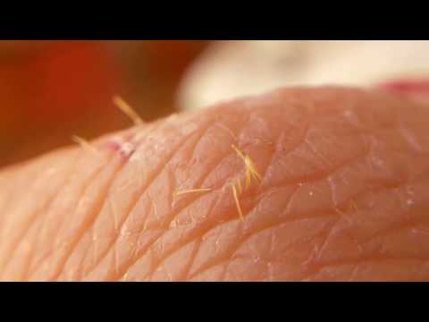 What Will Get Out Small Cactus Splinters