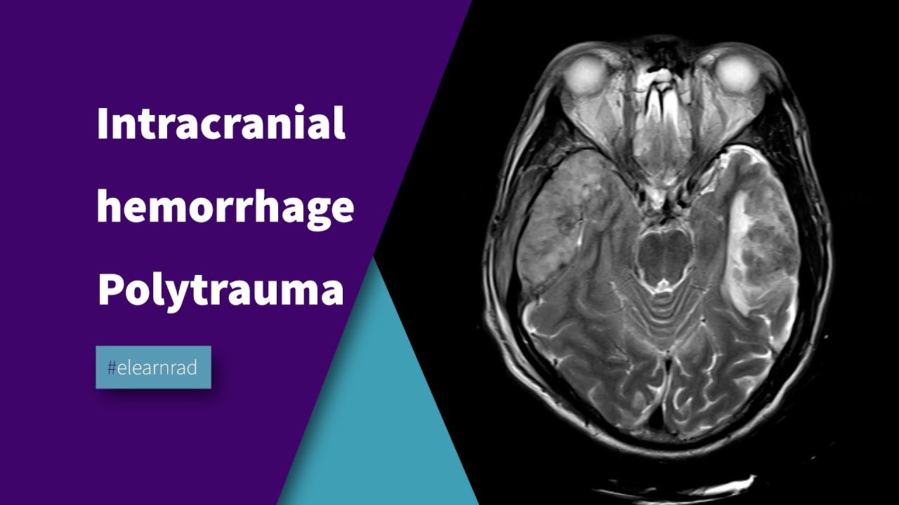 Intracranial hemorrhage in a polytrauma - YouTube