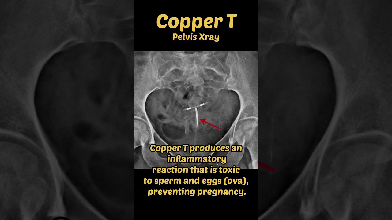 IUD on X-Ray: What's Normal? 7 Things You NEED to Know! - Babymoms.blog