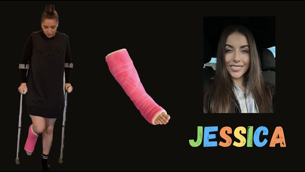 Short Leg Cast - YouTube