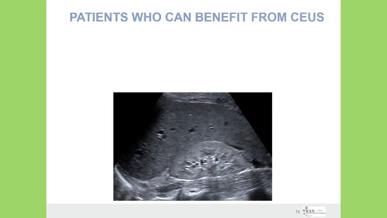 IAC & ICUS Present: Introduction to Contrast Enhanced Ultrasound for ...