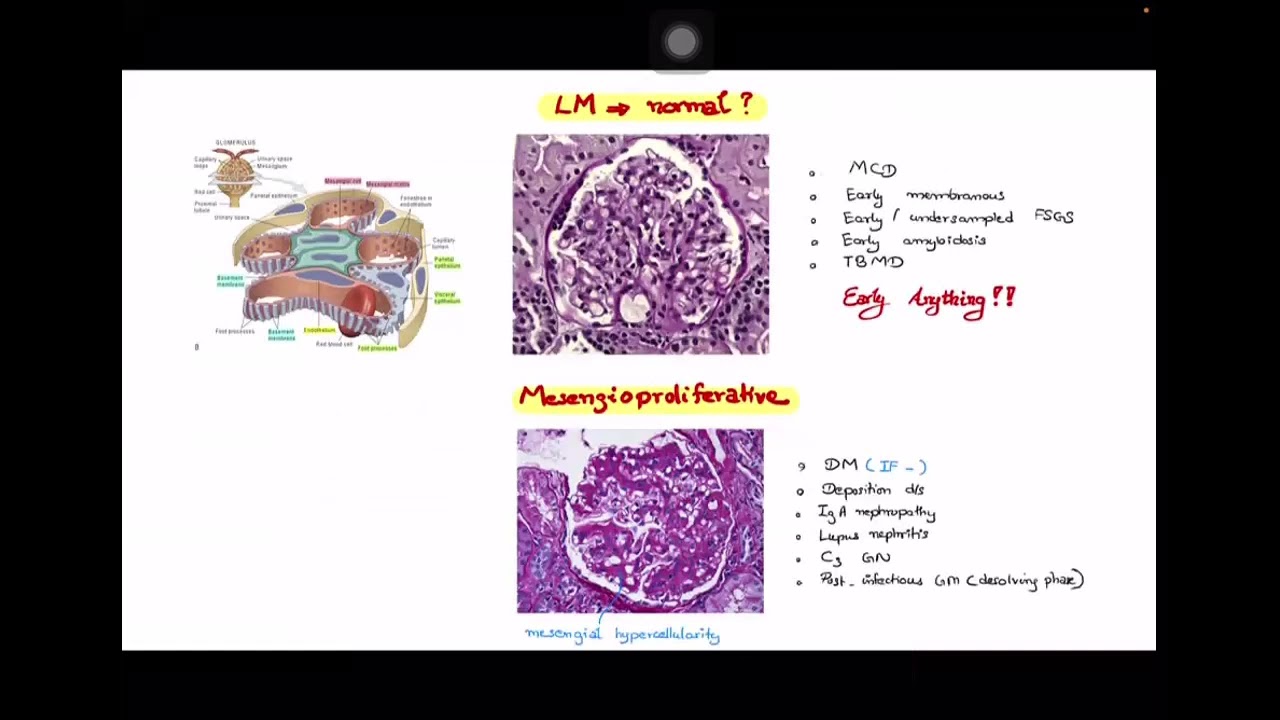 Pathophysiology of Glomerular Disease Revisited(Practical Approach from ...