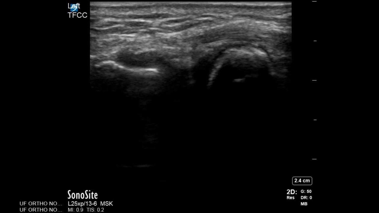 Wrist US TFCC Injection (out of plane) - YouTube