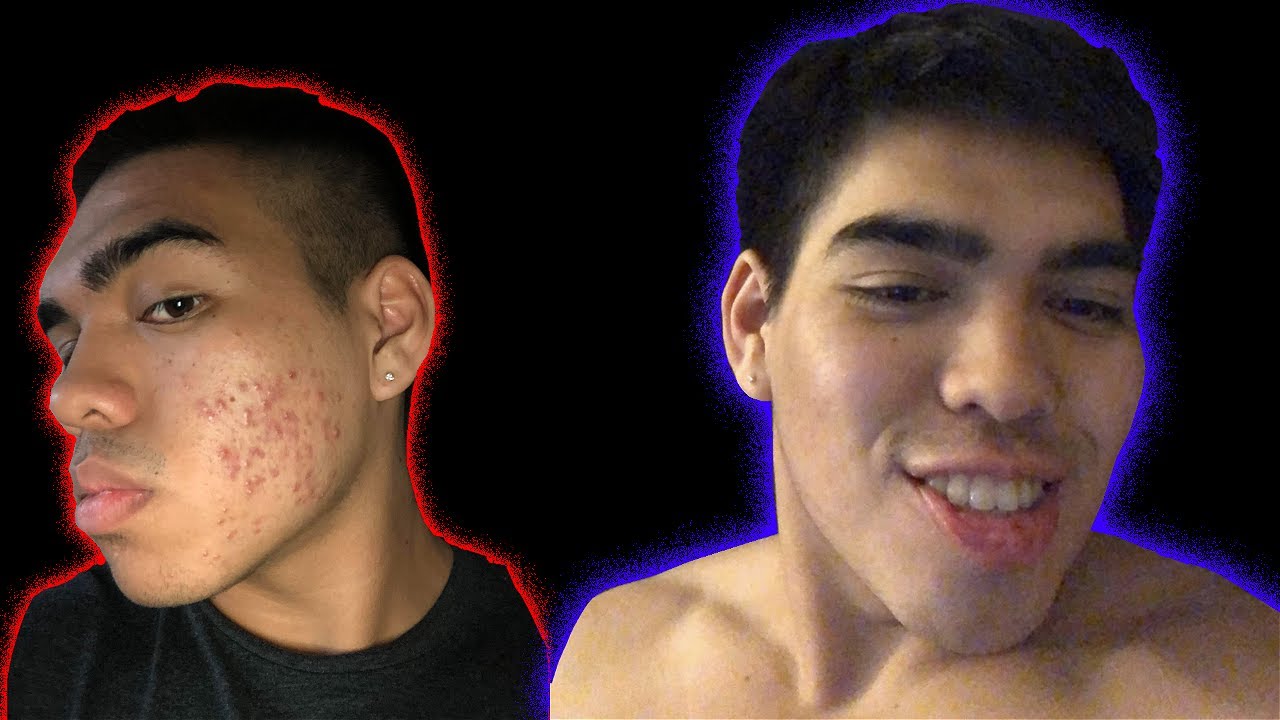 My Acne Face Transformation - 1 Year Timelapse - YouTube