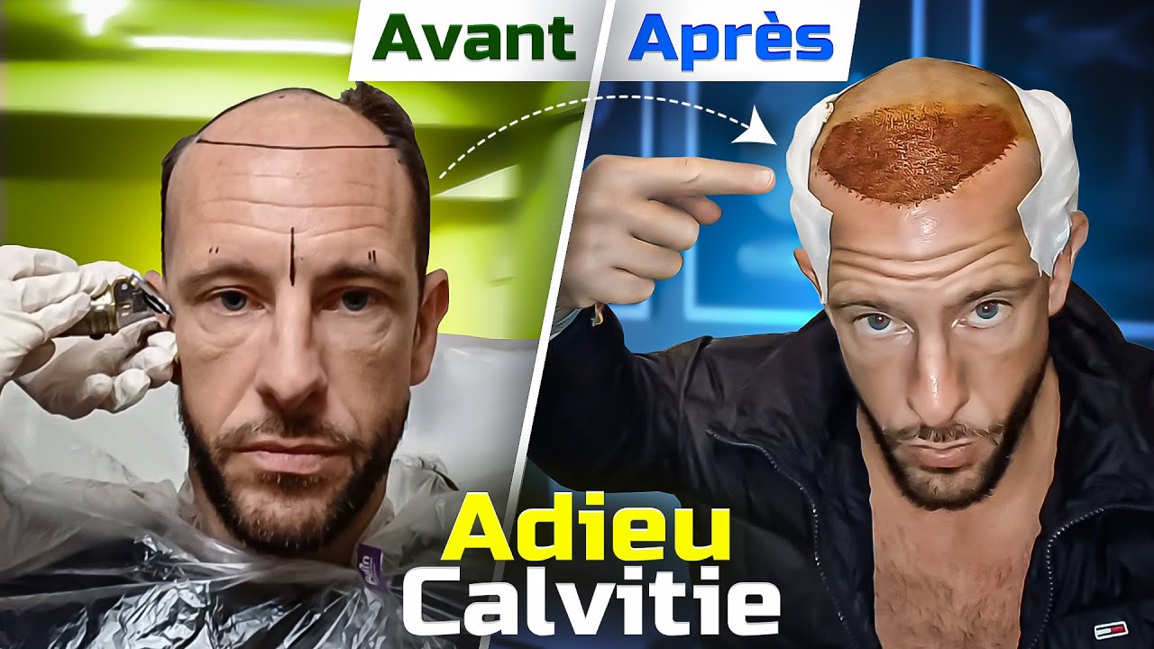 🟢Jour J | Opération GREFFE CAPILLAIRE DHI en Turquie 🇹🇷 - ADIEU MA ...