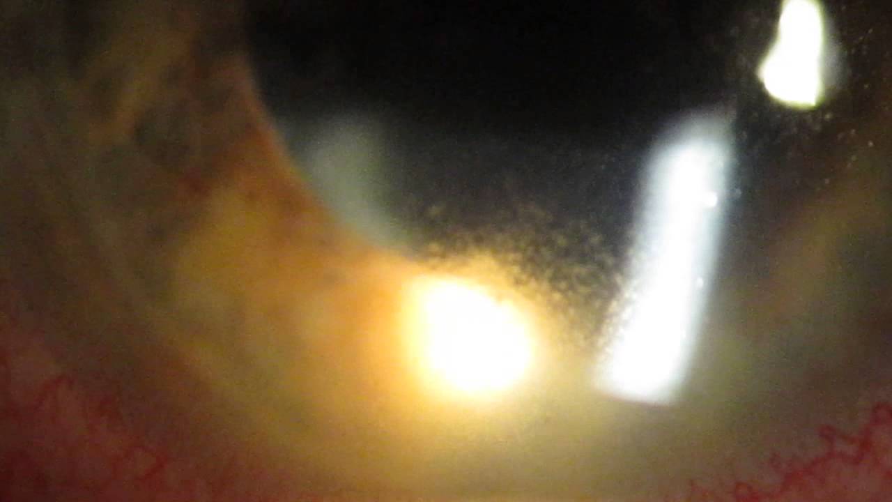 Acute severe Recurrent anterior Uveitis/complicating Psoriatic ...