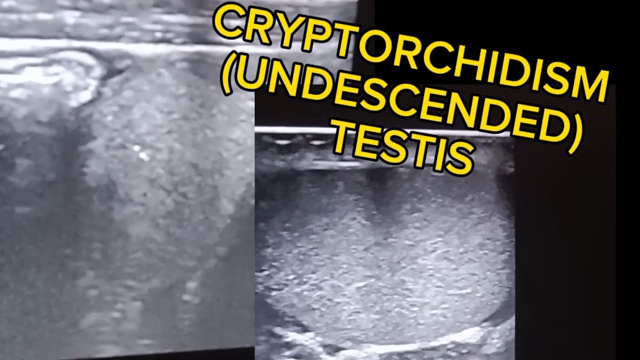 Undescended Testis Cryptorchidism A Closer Look Through Ultrasound