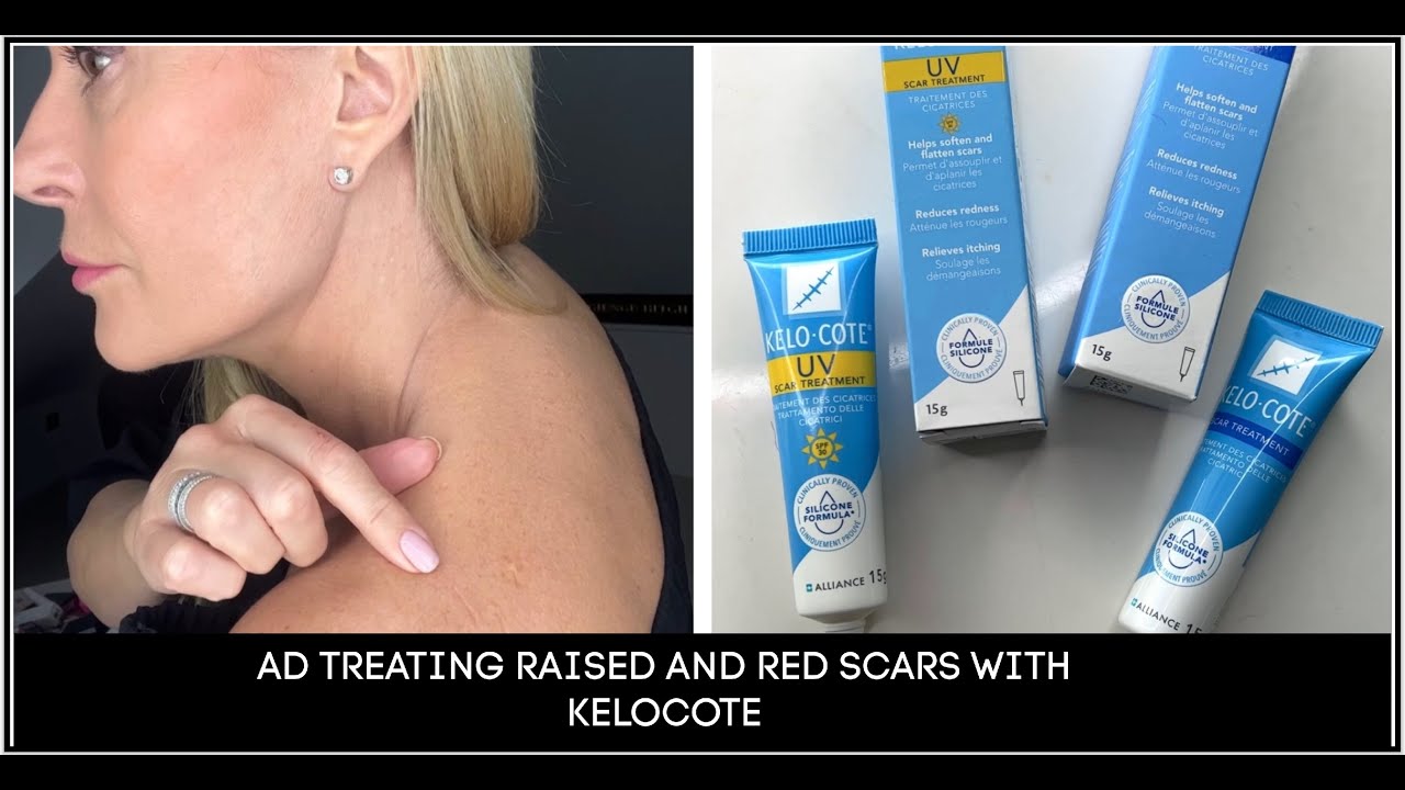 AD TREATING RAISED RED SCARS WITH KELOCOTE - YouTube