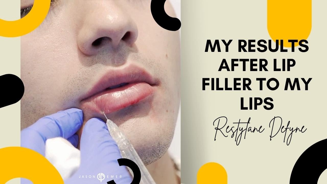 MY RESULTS AFTER LIP FILLER TO MY LIPS | Restylane Defyne | Dr. Jason ...