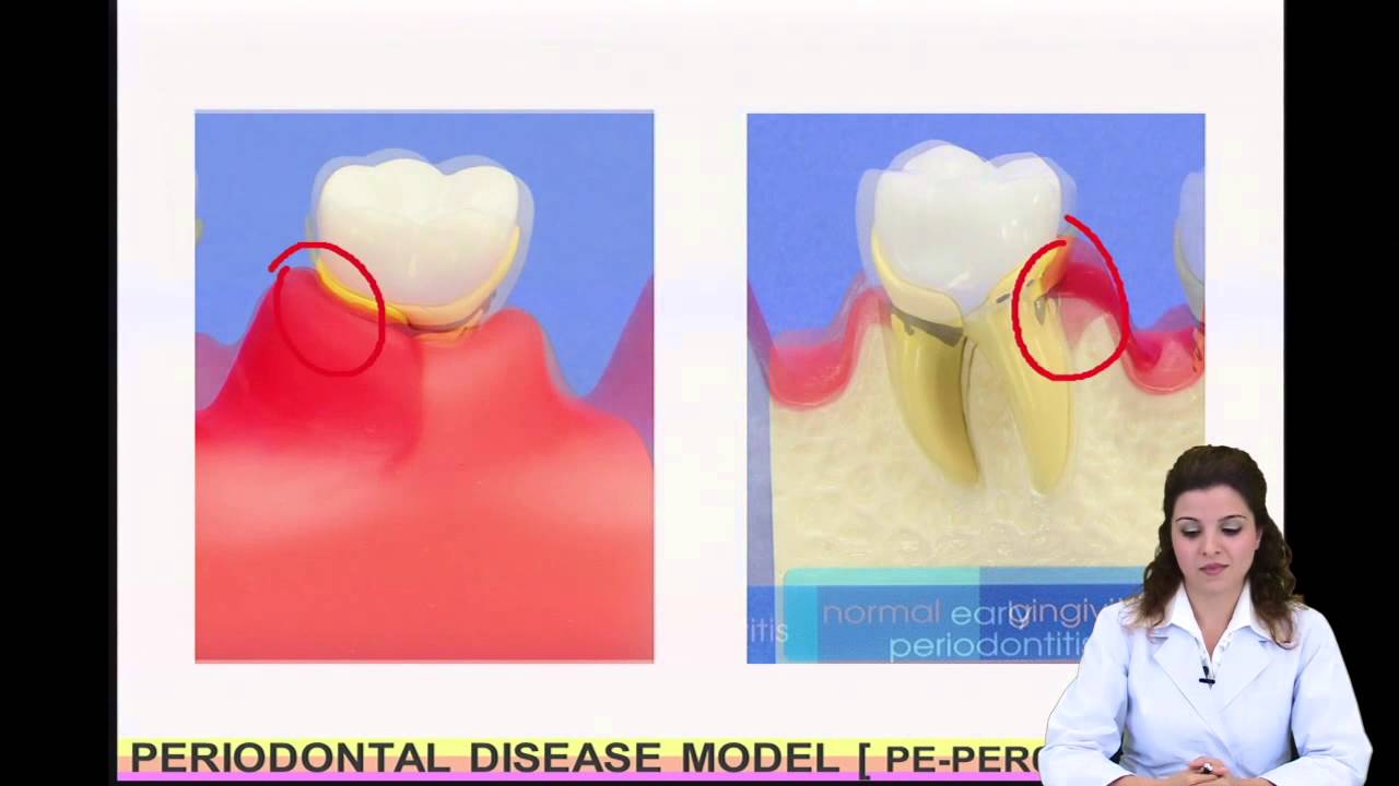 NISSIN: PERIODONTAL DISEASE MODEL [PE-PER010] - YouTube