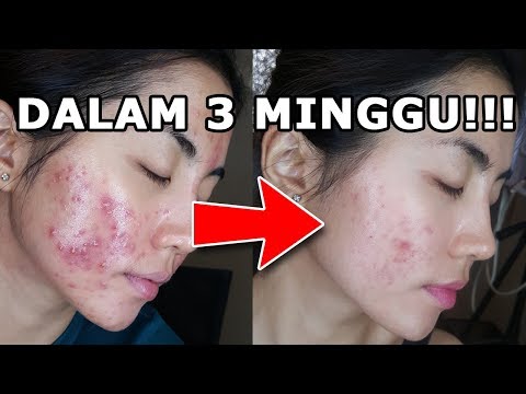 BEBAS JERAWAT DENGAN DIET