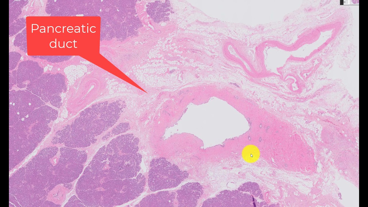Pancreatic Duct Slide