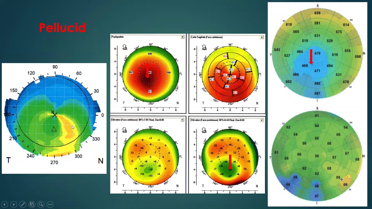 HD Corneal OCT : Diaporama | S. Mahjoub - YouTube