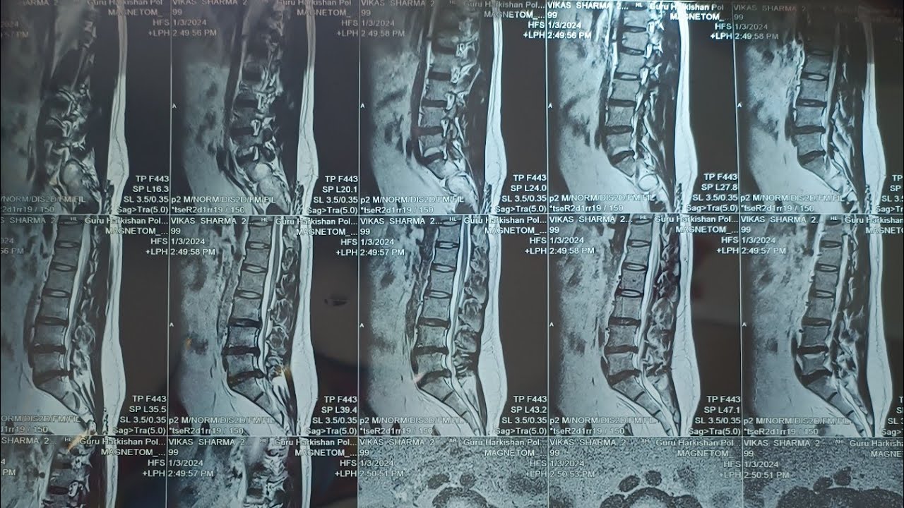 L4 L5 S1 Disc bulge,Disc decompression, Rod implant In Disc , Disc ...