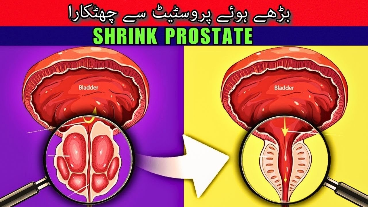 How To Shrink Enlarged Prostate Naturally - پروسٹیٹ کی بیماری کا خود ...