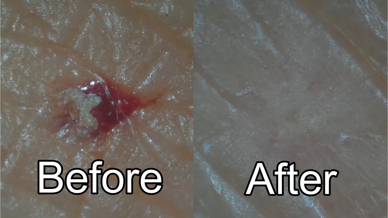 15 Days Wound Healing Timelapse Under A Microscope - YouTube