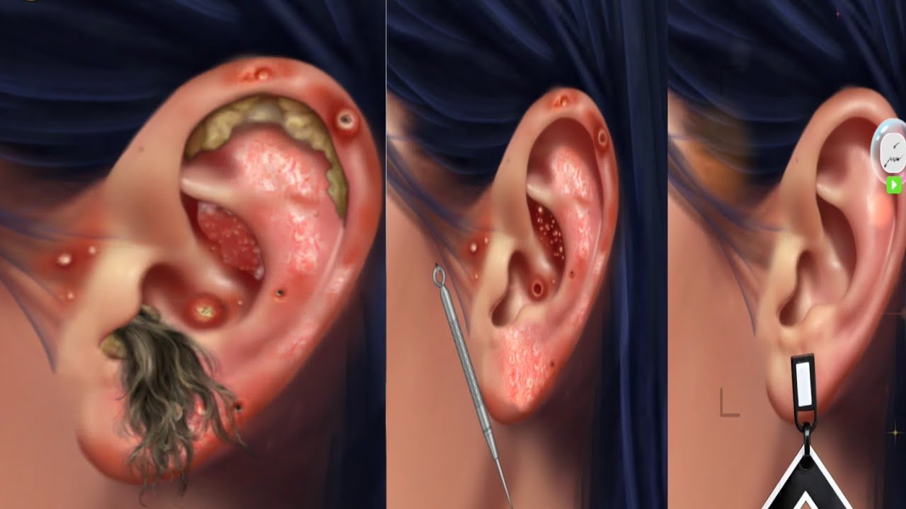 Asmr Ear Cleaning and Wax Removal Game | ASMR Makeover Game - YouTube