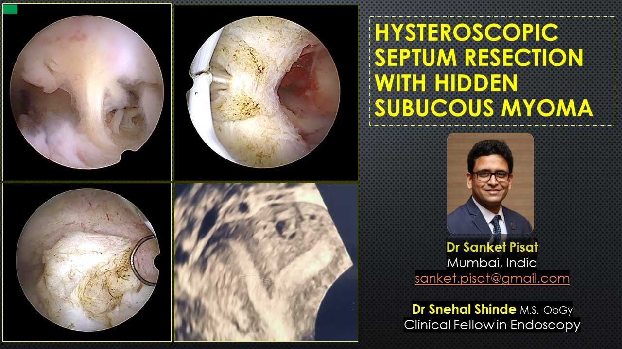 Septum resection with hidden submucous fibroid | With Voiceover - YouTube