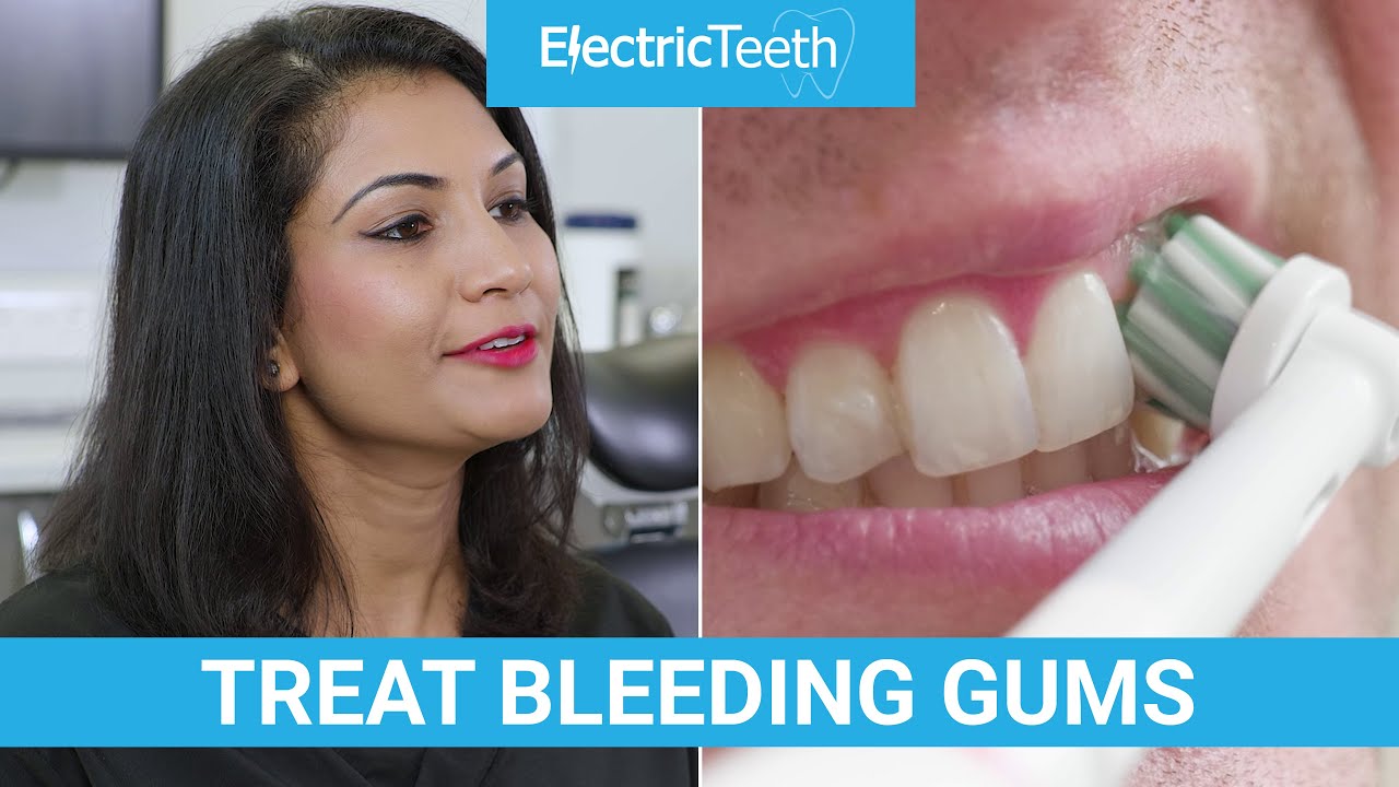 How to treat bleeding gums at home - YouTube