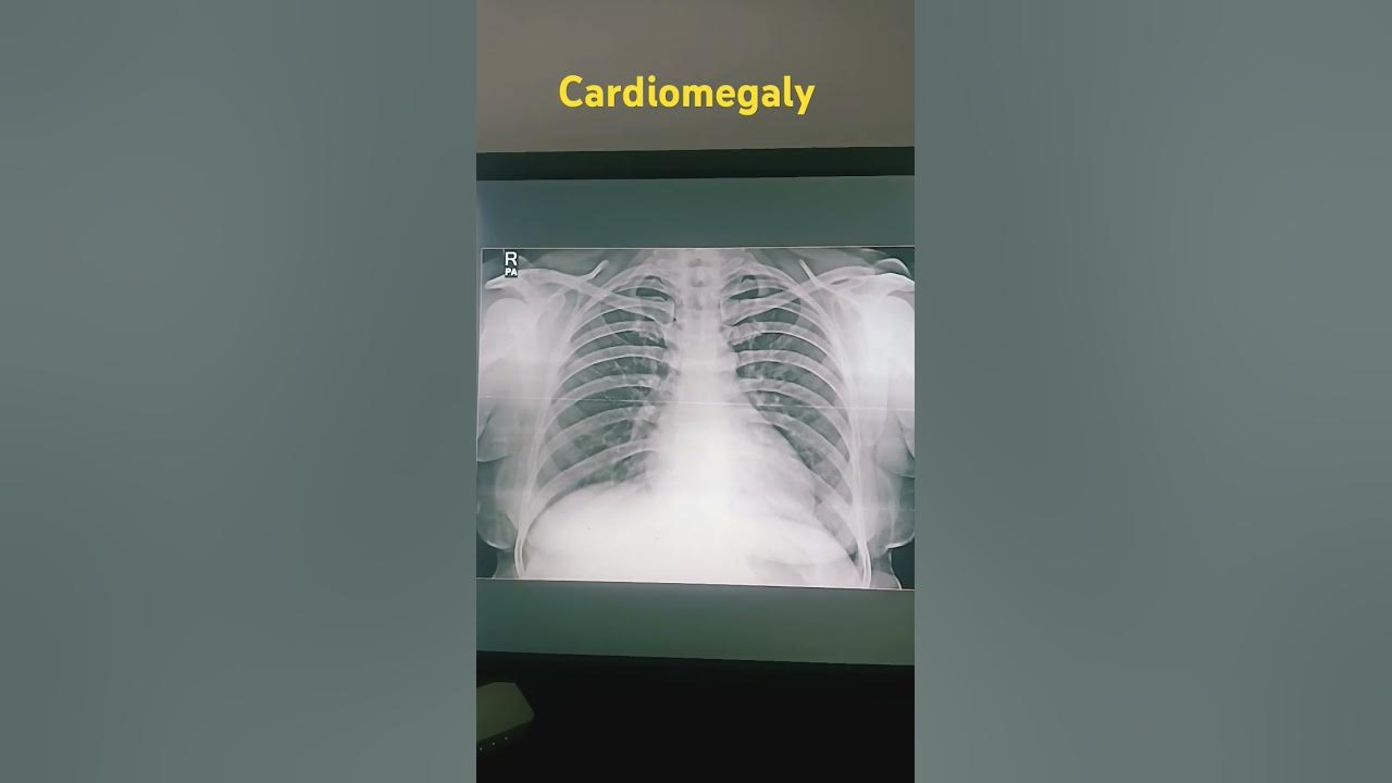 xray Chest pa Cardiomegaly enlarge - YouTube