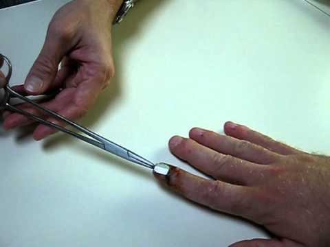Kent Trivette getting metal pin pulled out of finger - YouTube