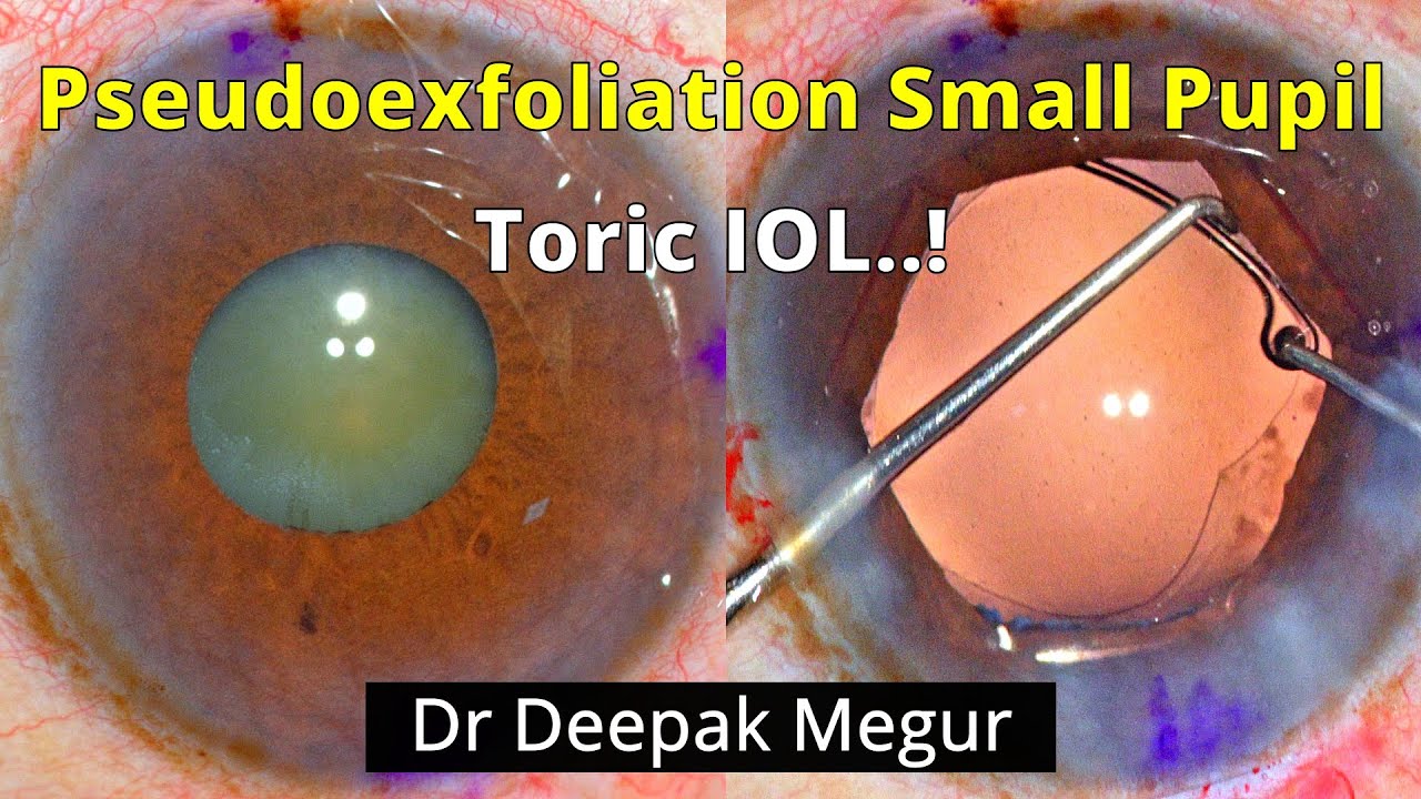 Phacoemulsification in an eye with small pupil and a Toric IOL - Dr ...