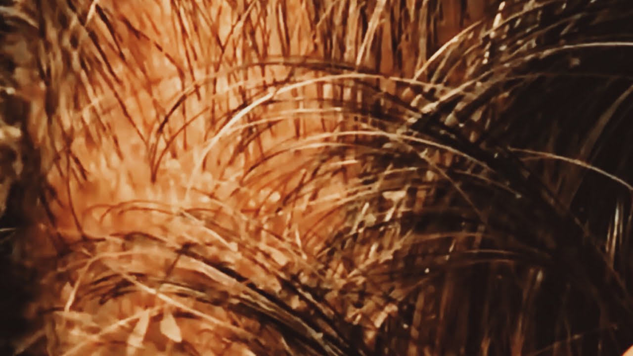 Dandruff Scraping - YouTube