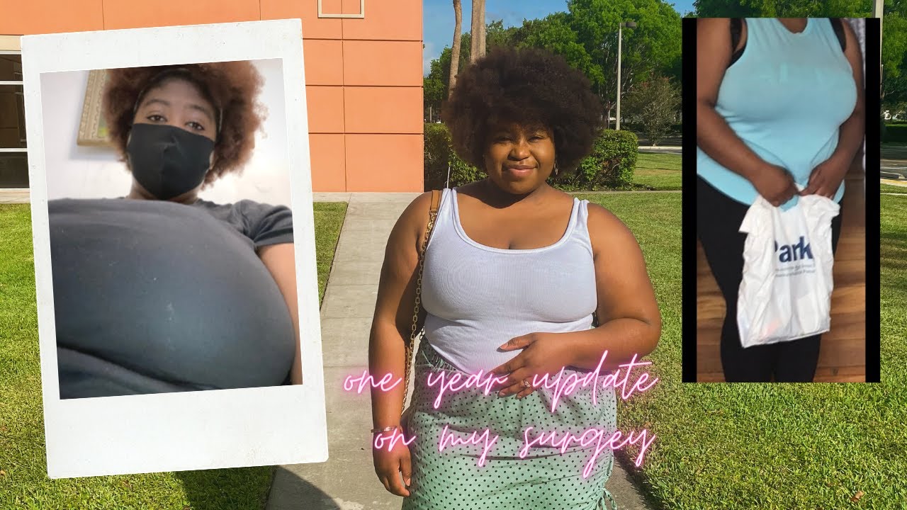 ONE YEAR UPDATE ON MY BREAST REDUCTION---TAKING LEGAL ACTION, REGRET ...