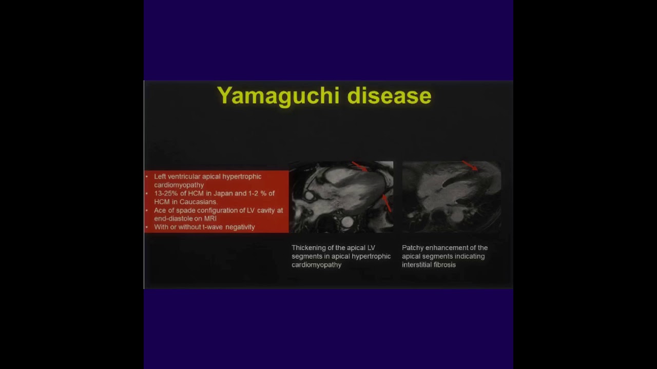 Yamaguchi Syndrome Echocardiogram - YouTube