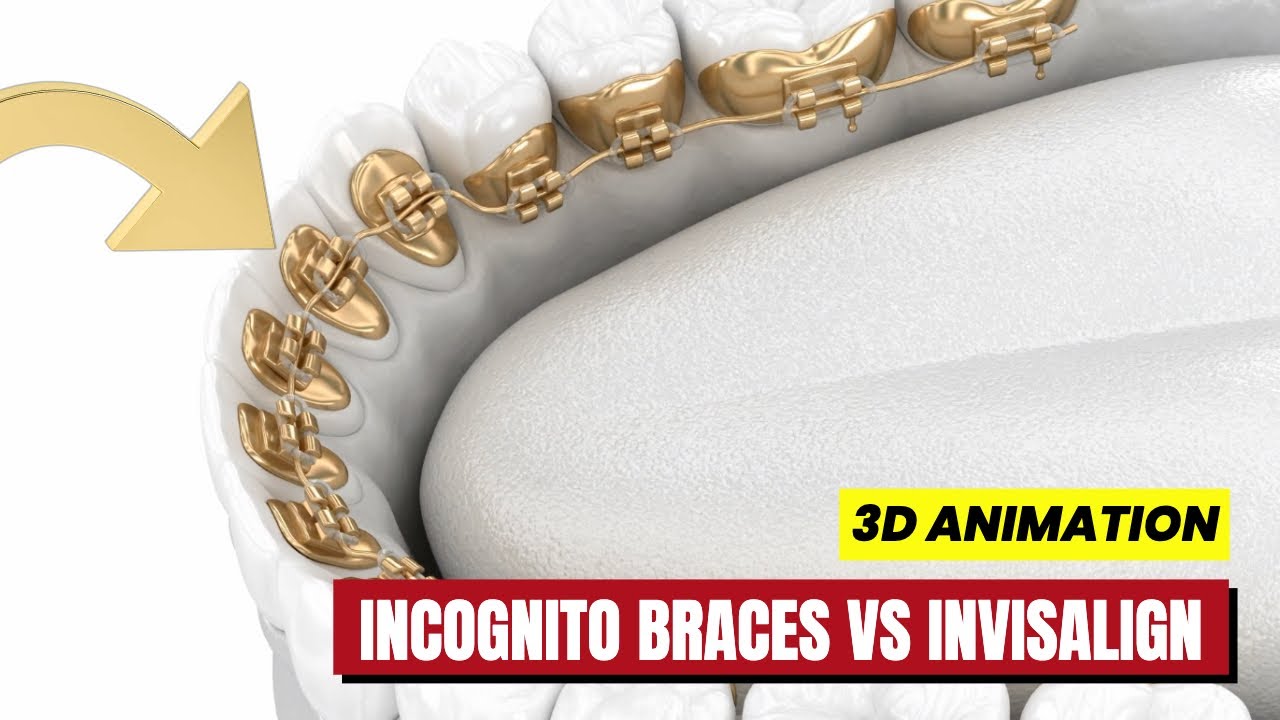 INCOGNITO BRACES vs INVISALIGN Hidden Braces Behind Teeth EXPOSED | 3D ...