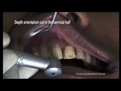 Indirect Composite Veneer Flexible model methodfinal - YouTube