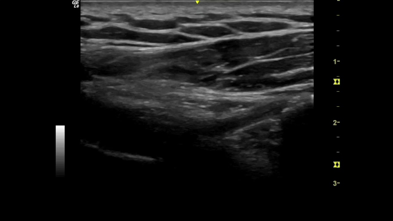 coracohumeral ligament in frozen shoulder - YouTube