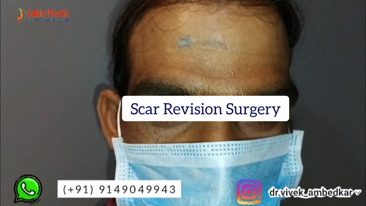 Scar Removal Surgery | Scar Revision | Face Scar | Vitiligo Patch ...