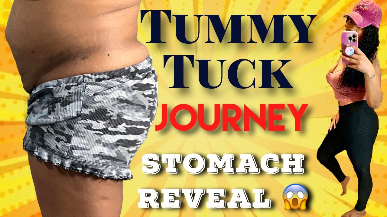 Tummy Tuck Post op update| Stomach Reveal | Plastic Surgery Vlog 2023 ...