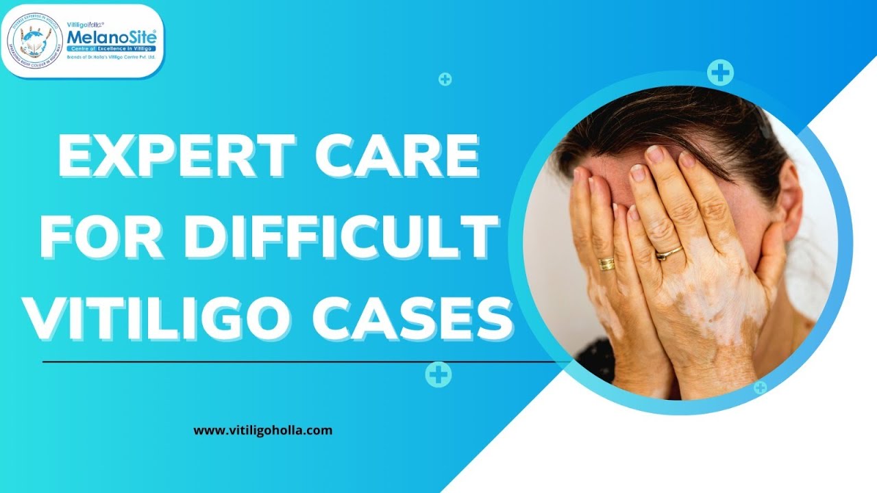 Advanced Vitiligo Management with Surgical Techniques at MelanoSite ...