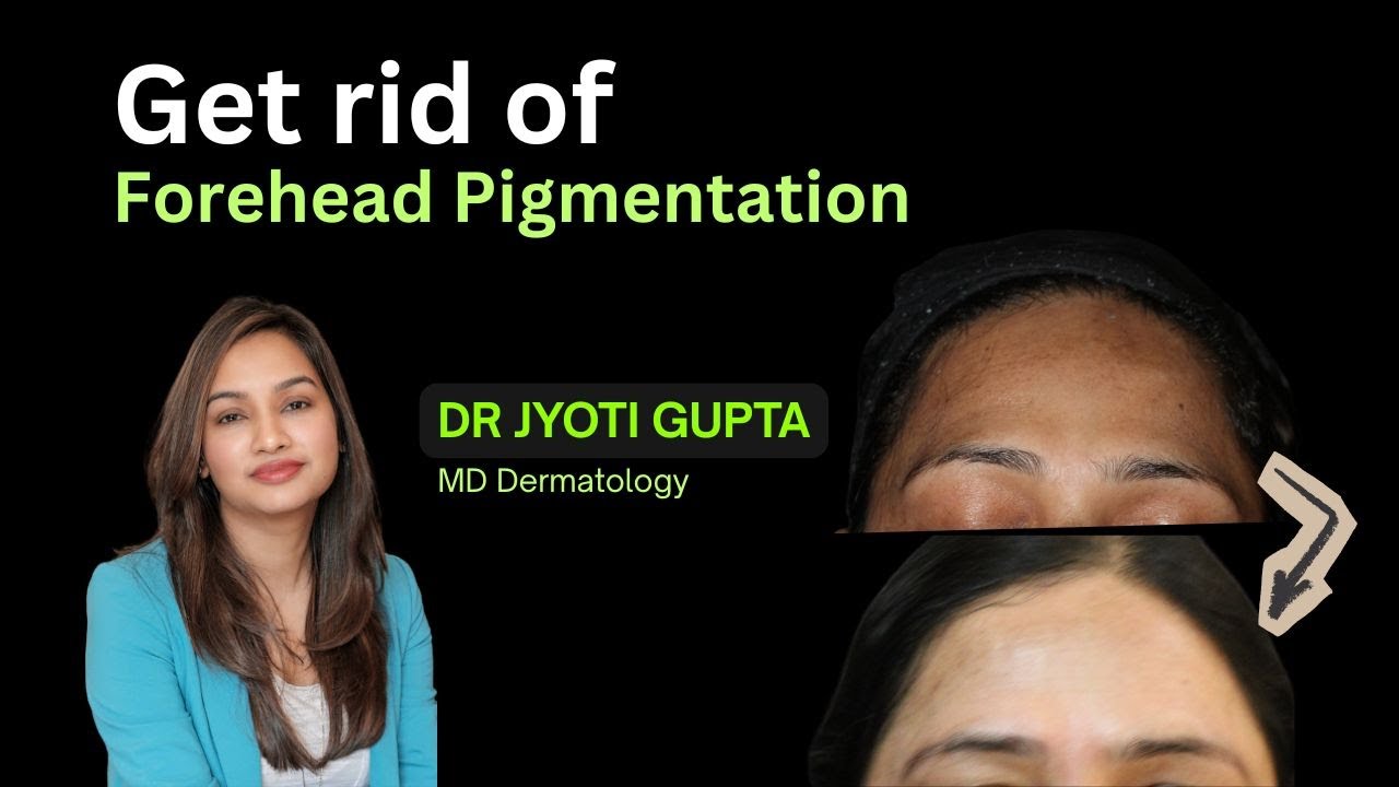 Dark Patches on Forehead? Here’s What’s Really Causing Them & How to ...