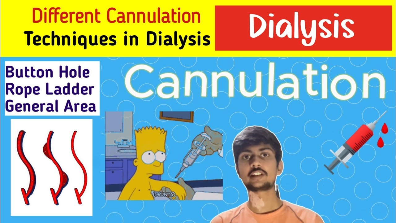 AVF Cannulation Techniques Explained: A Dialysis Guide - YouTube