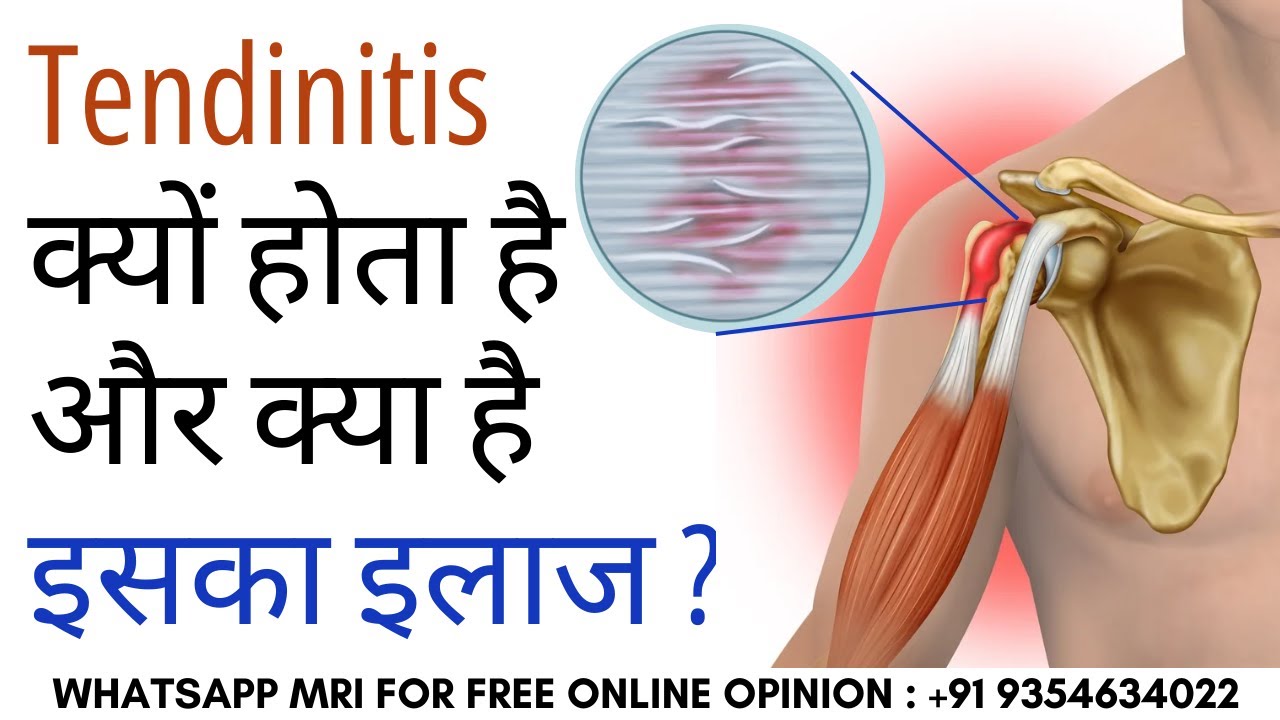 Tendinitis क्यों होता है और क्या है इसका इलाज ? Best Treatment for ...