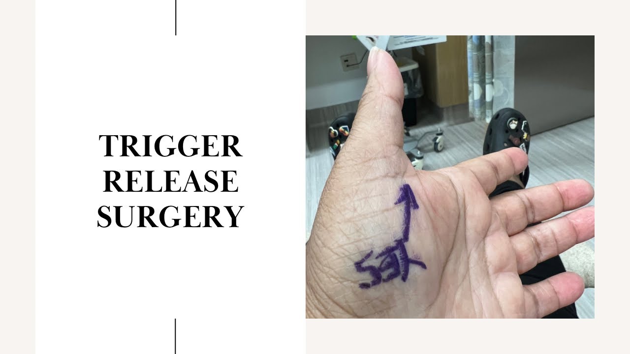 I had trigger release surgery. How I’m feeling now. - YouTube