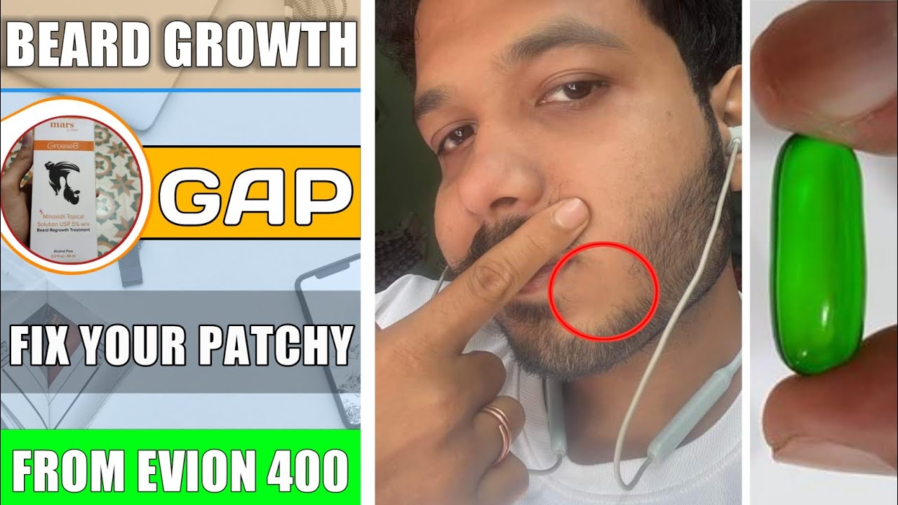 BEARD GROWTH FIX YOUR PATCHY BEARD || GROW BEARD FROM EVION 400 ...