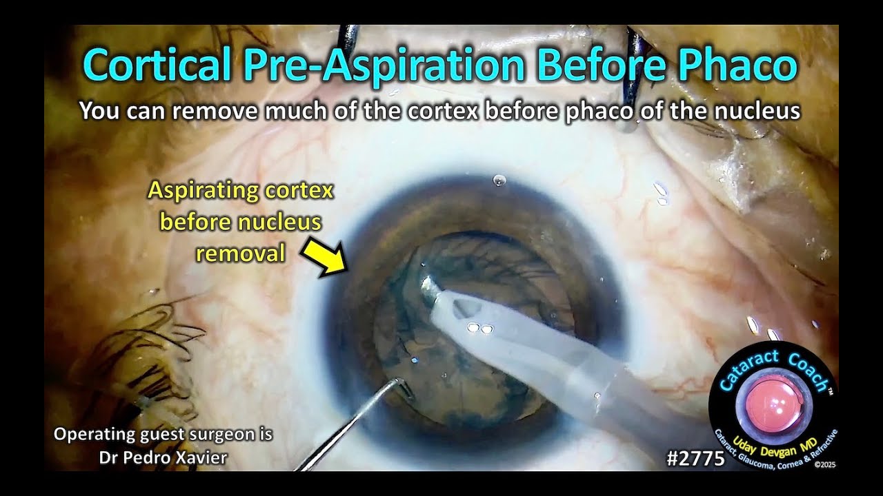 CataractCoach™ 2775: cortical pre-aspiration before phaco. cortex ...