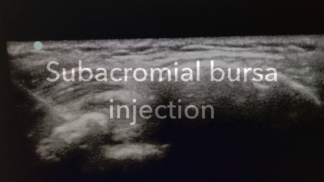 Supraspinatus Calcific Tendinosis Fenestration - YouTube