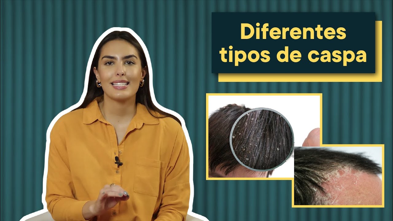 Quais os tipos de caspa e como tratar? - YouTube