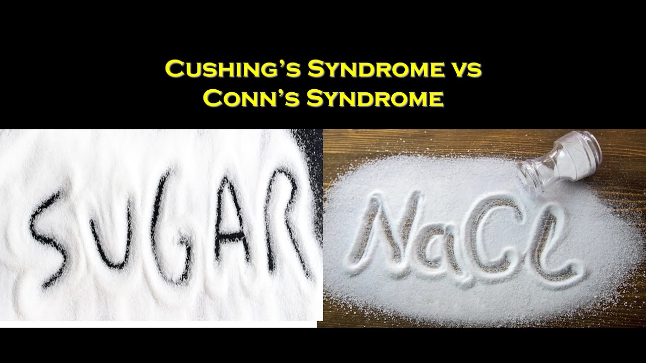 78r - Cushing’s Syndrome vs Conn’s Syndrome - YouTube