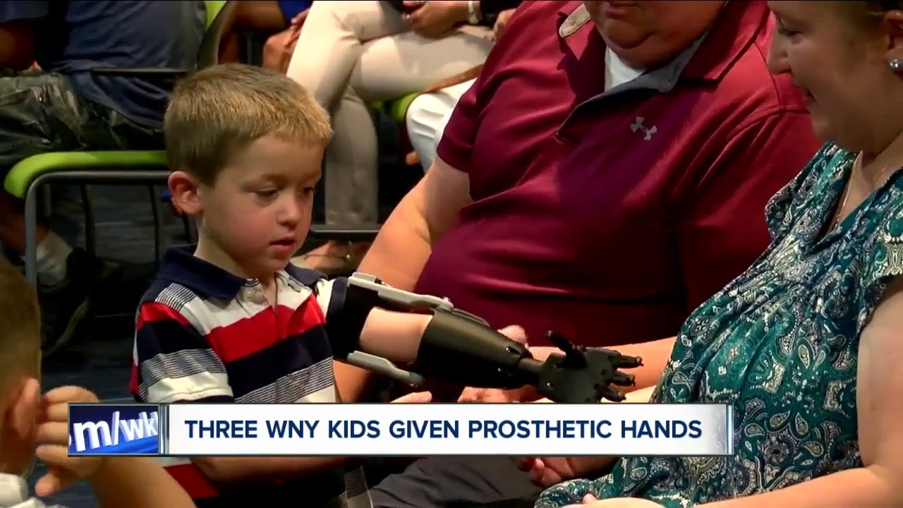 Three kids given new prosthetic hands - YouTube