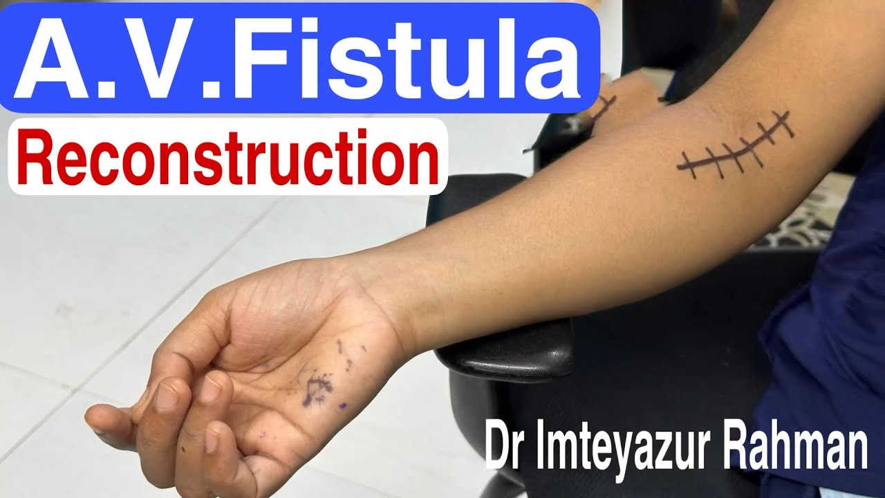 Arteriovenous fistula, fistula reconstruction, Acute & chronic renal ...