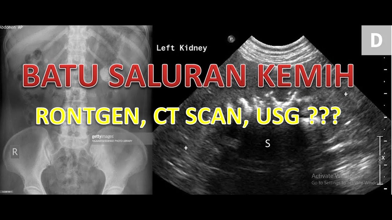 Gambaran Radiologi Batu Saluran Kemih Rontgen USG CT Scan YouTube