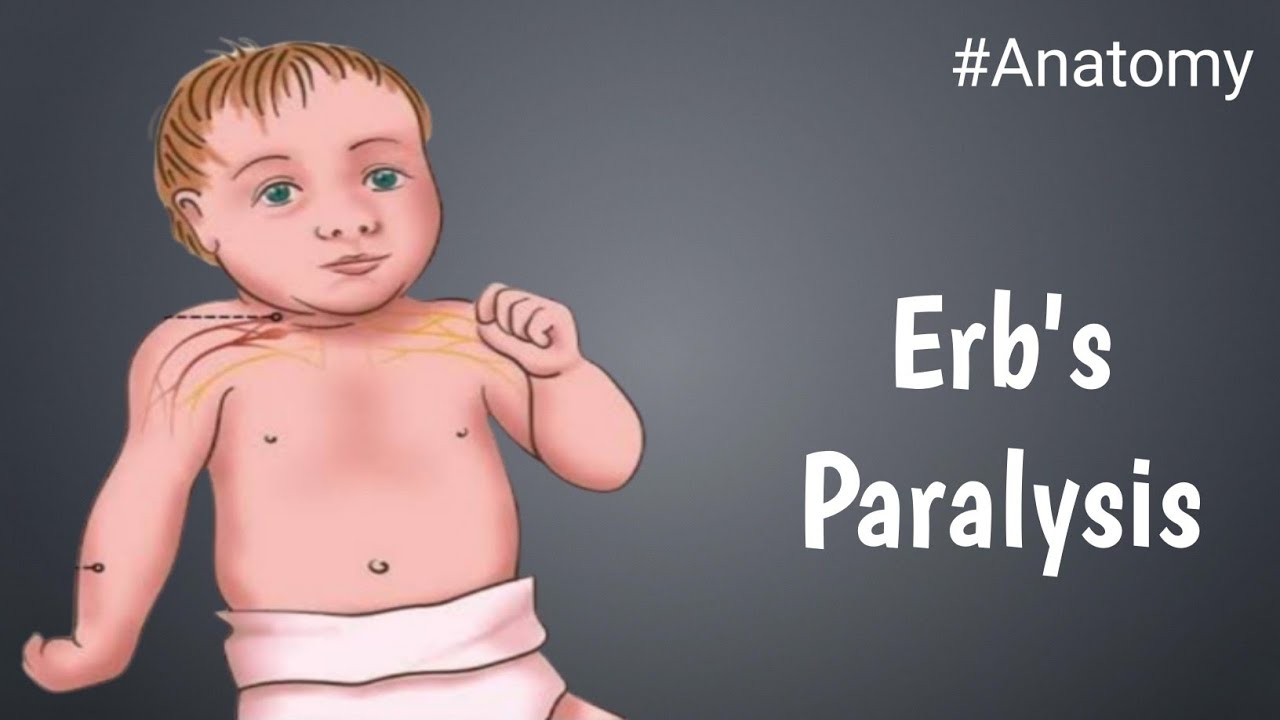 Erb's Paralysis #anatomy #mbbs #youtube #study #mbbsmotivation # ...