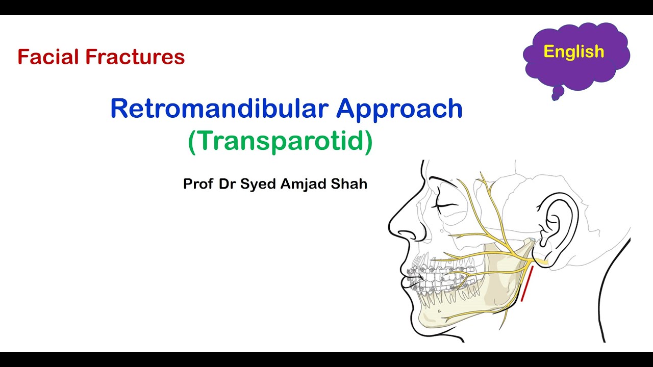 Retromandibular Approach | Transparotid | Oral & Maxillofacial Surgery ...