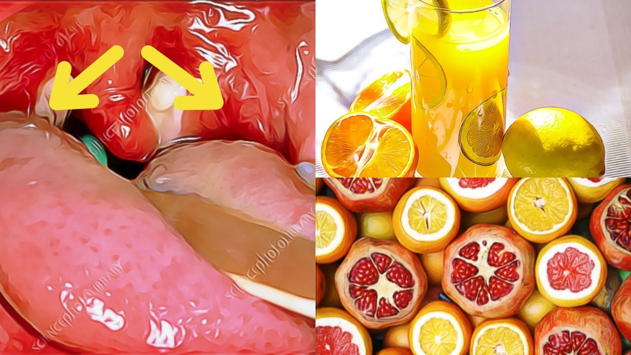 How to Cure Tonsillitis Fast and Naturally || Home Remedies Tonsillitis ...
